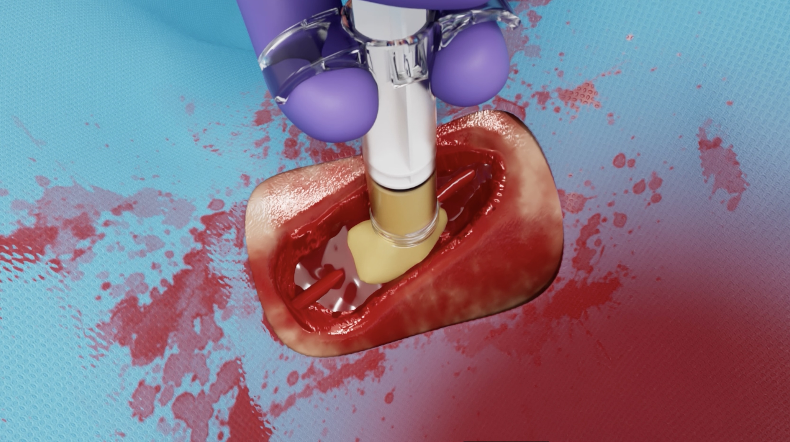 Trauma Care - Cresilon